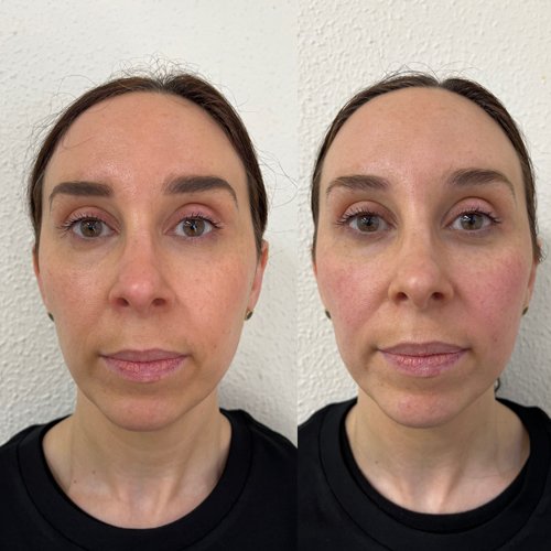 Face Sculpting | Buccal Massage Brisbane | Heart Space Beauty