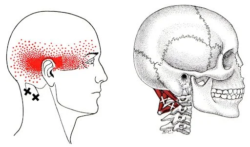 Referred vs Radicular Pain: What is the difference and why does it ...