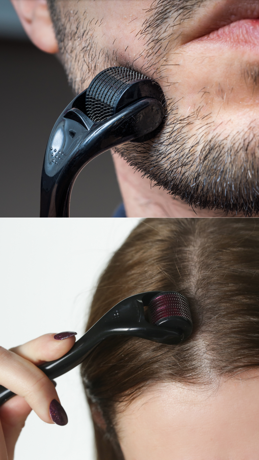 Unlocking Scalp Health and Hair Growth with Derma-Rollers — NHL Med ...