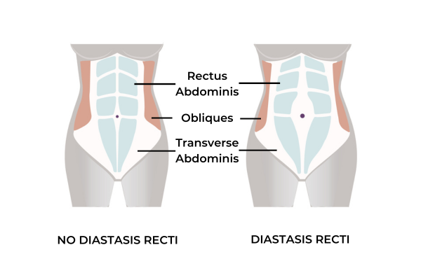 Diastasis Recti: What it is and how to prevent it — Fit With Sally