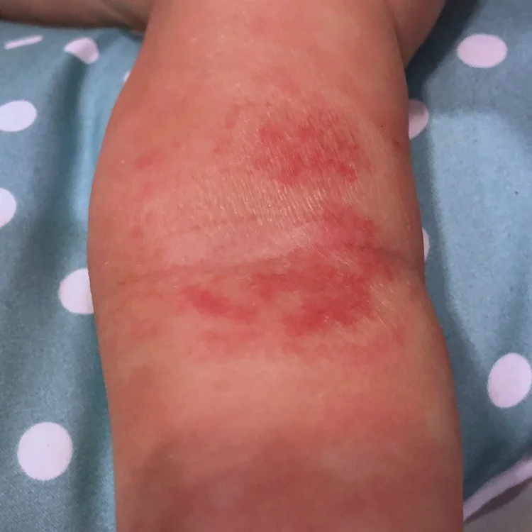 Solution EC: Damp Heat Herbal Ointment — CMD Skin Solutions