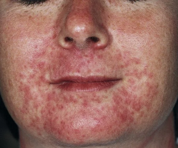 That Rash Around Your Mouth Might Be Perioral Dermatitis — CMD Skin ...