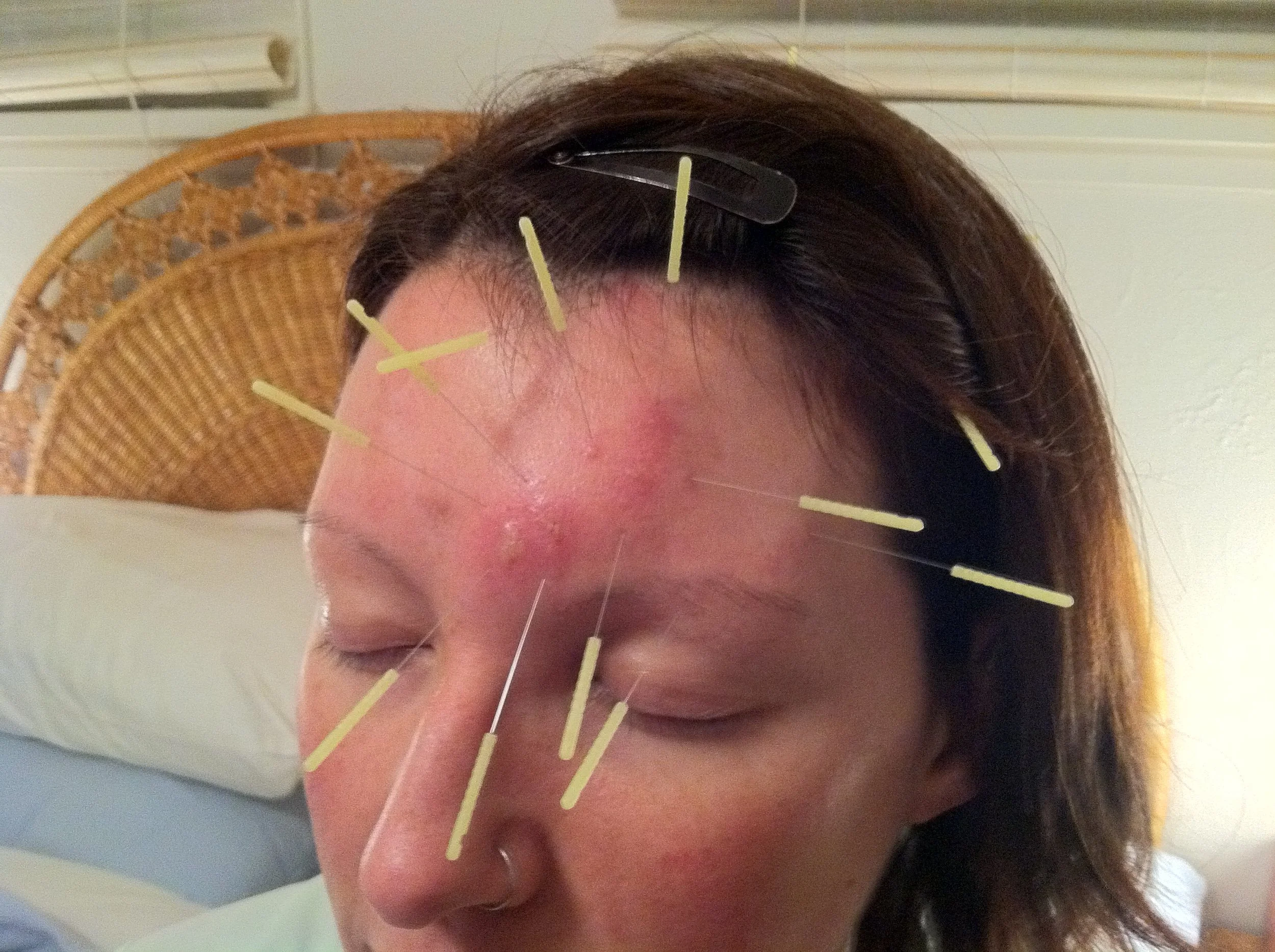 What Having Shingles Felt Like and How I Treated It — CMD Skin Solutions