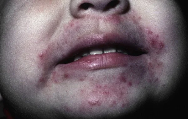 That Rash Around Your Mouth Might Be Perioral Dermatitis — CMD Skin ...