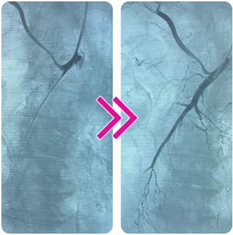 Case Reports — Pounce™ Thrombectomy System
