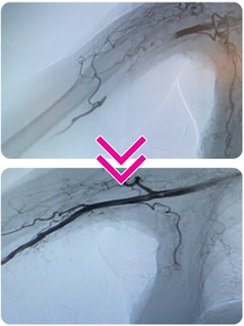 Case Reports — Pounce™ Thrombectomy System