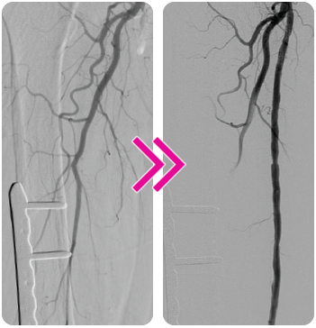 Case Reports — Pounce™ Thrombectomy System