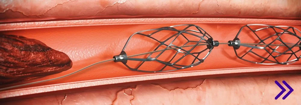 Product — Pounce™ Thrombectomy System