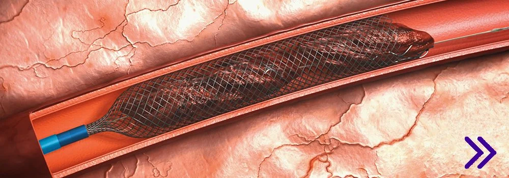 Product — Pounce™ Thrombectomy System