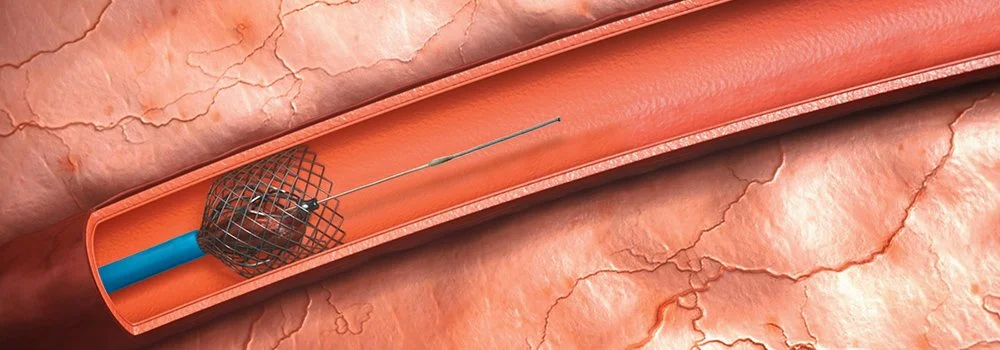 Product — Pounce™ Thrombectomy System