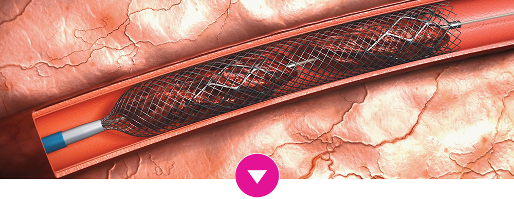 Product — Pounce™ Thrombectomy System