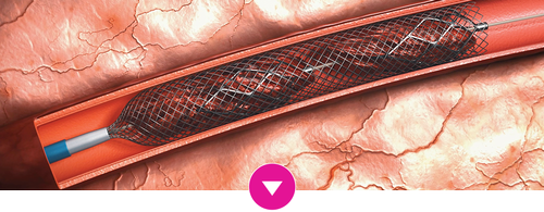 Product — Pounce™ Thrombectomy System