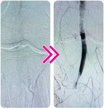 Case Reports — Pounce™ Thrombectomy System