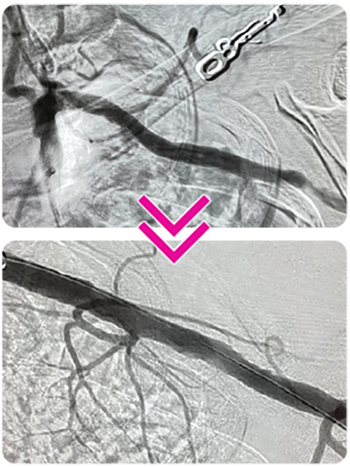 Case Reports — Pounce™ Thrombectomy System