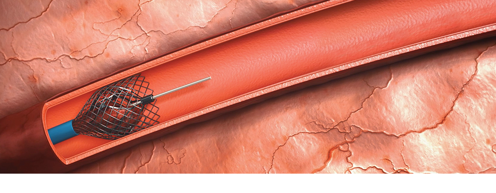 Product — Pounce™ Thrombectomy System