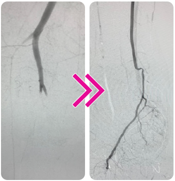 Case Reports — Pounce™ Thrombectomy System
