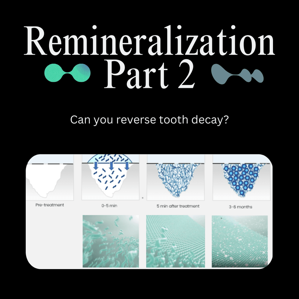 Remineralization Part 2 — LAT Dentistry