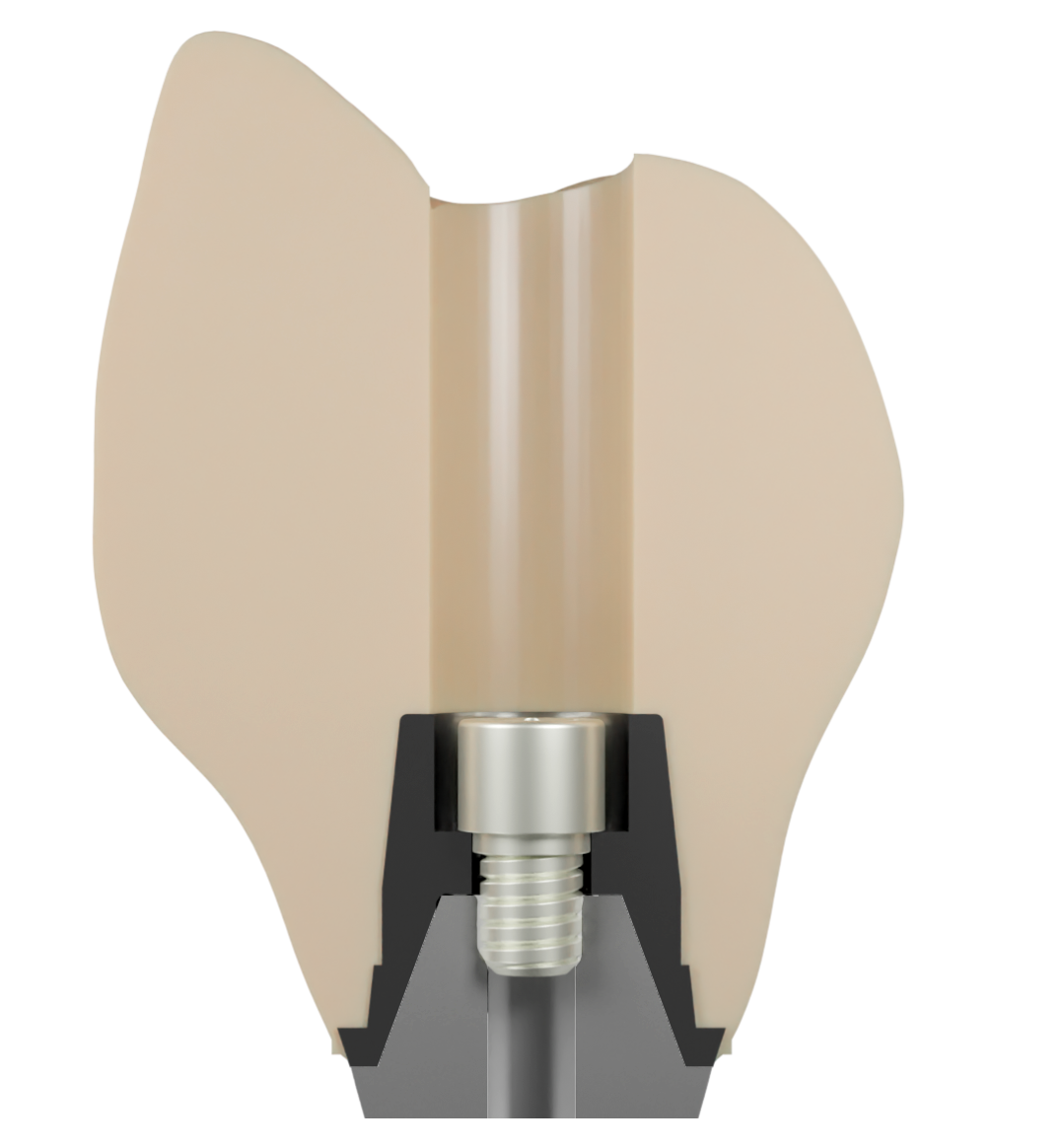 Nexus iOS Immediate Full-Arch Dental Prosthetics — Nexus iOS