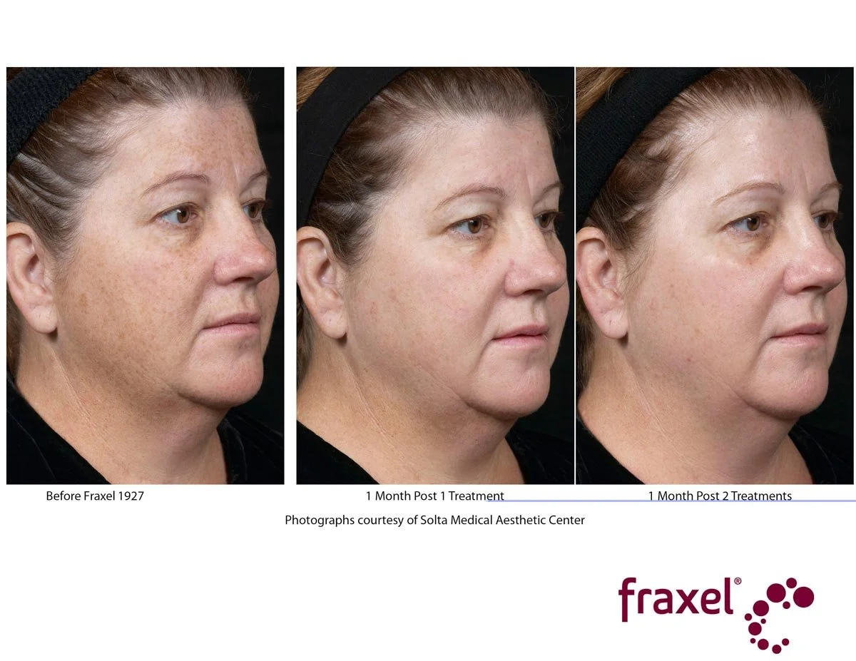 Fraxel DUAL — North Point Dermatology & Mohs Surgery