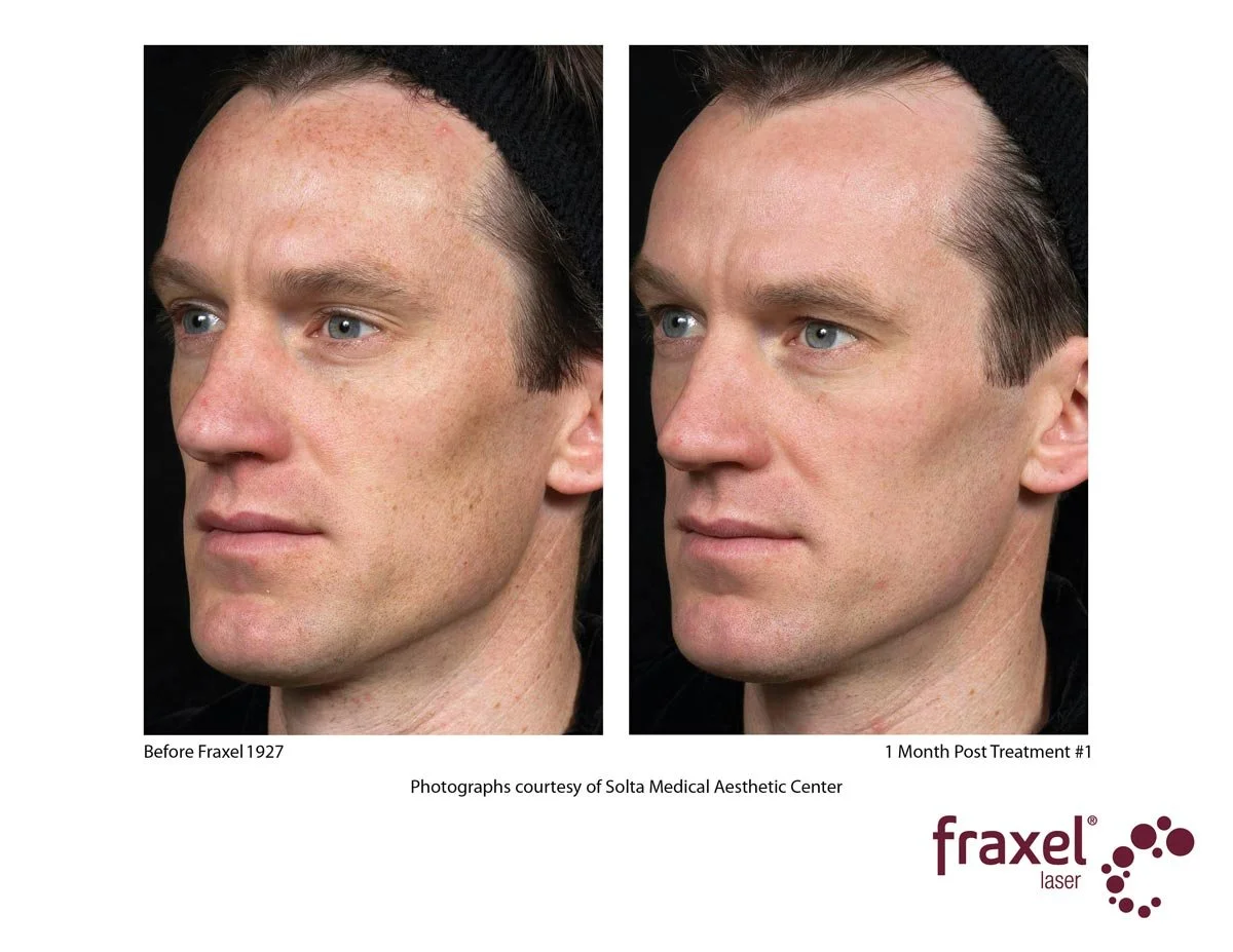 Fraxel DUAL — North Point Dermatology & Mohs Surgery