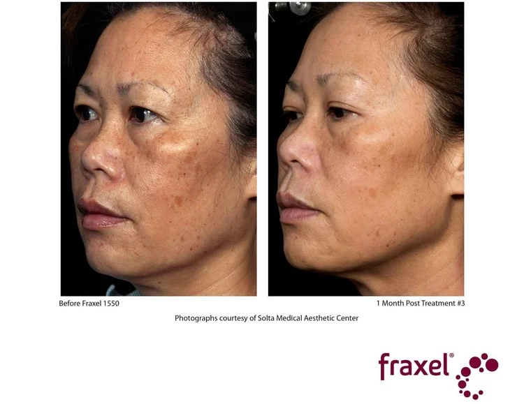 Fraxel DUAL — North Point Dermatology & Mohs Surgery