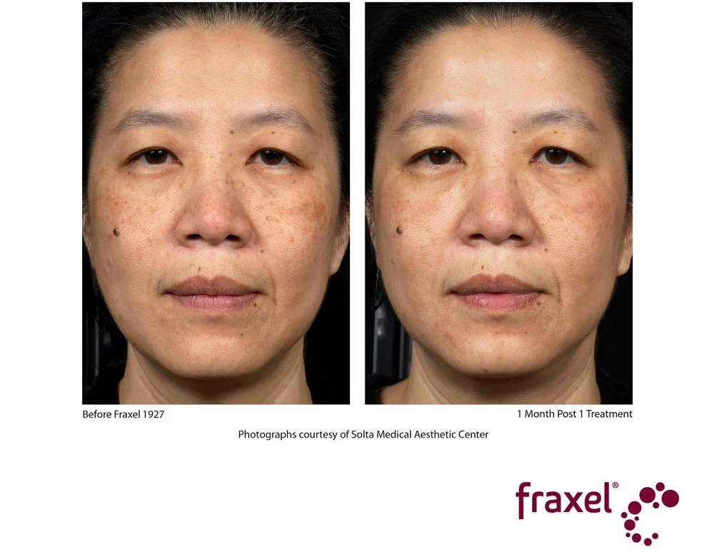 Fraxel DUAL — North Point Dermatology & Mohs Surgery