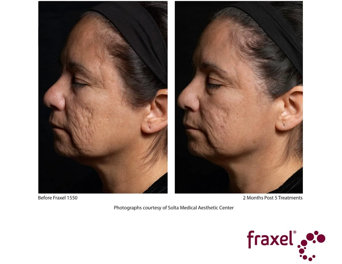 Fraxel Dual North Point Dermatology Mohs Surgery