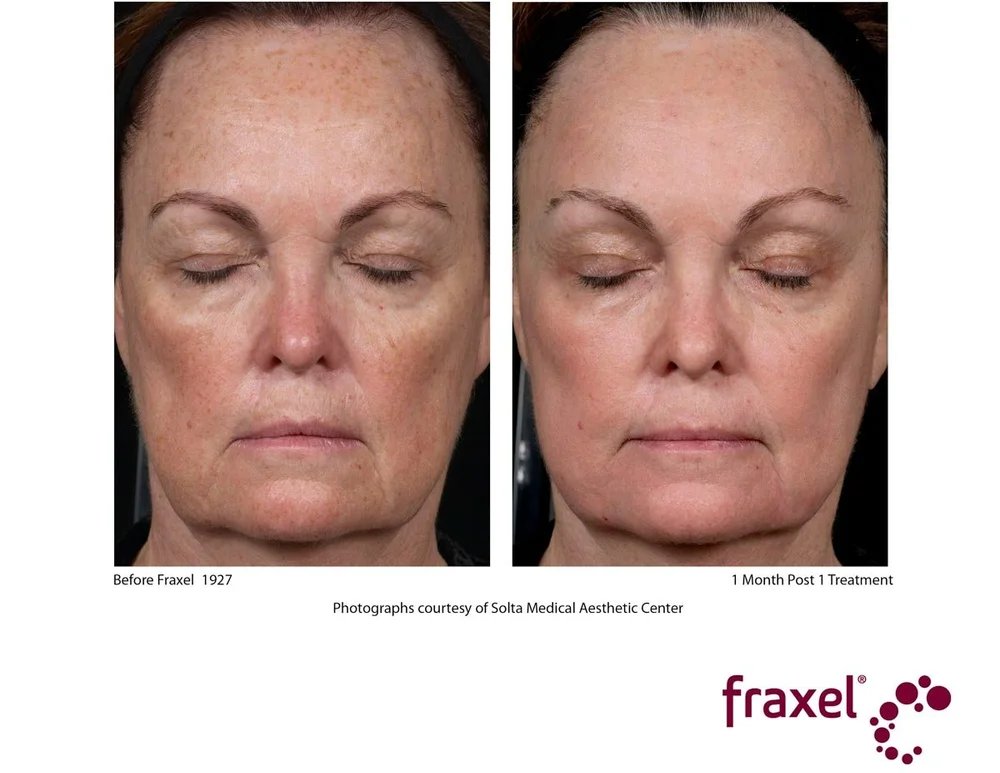 Fraxel DUAL — North Point Dermatology & Mohs Surgery