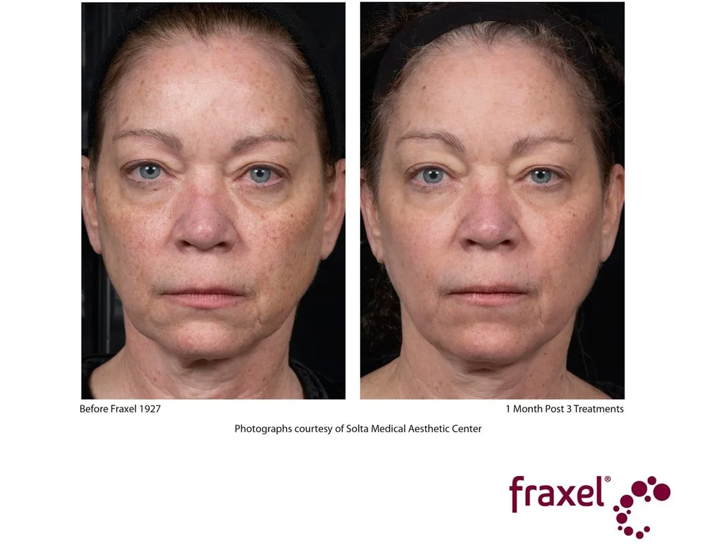 Fraxel DUAL — North Point Dermatology & Mohs Surgery