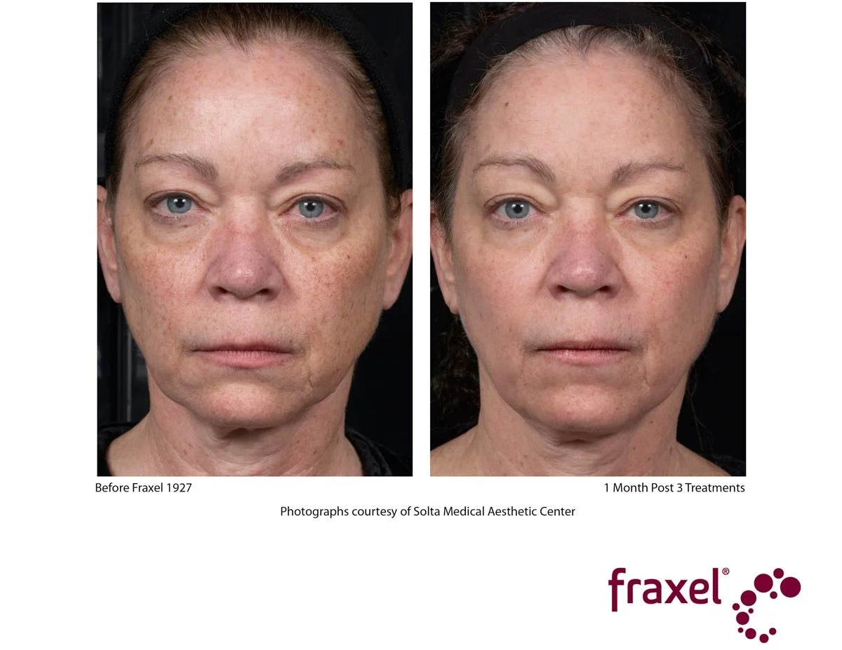 Fraxel DUAL — North Point Dermatology & Mohs Surgery
