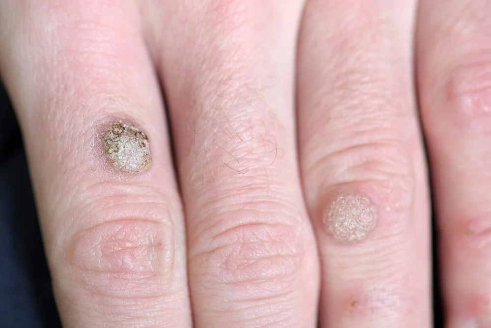 Warts — North Point Dermatology & Mohs Surgery