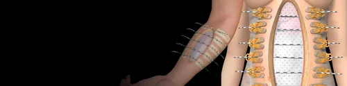 ABRA Dynamic Tissue System | ABRA Abdominal Wound Closure — Conduit