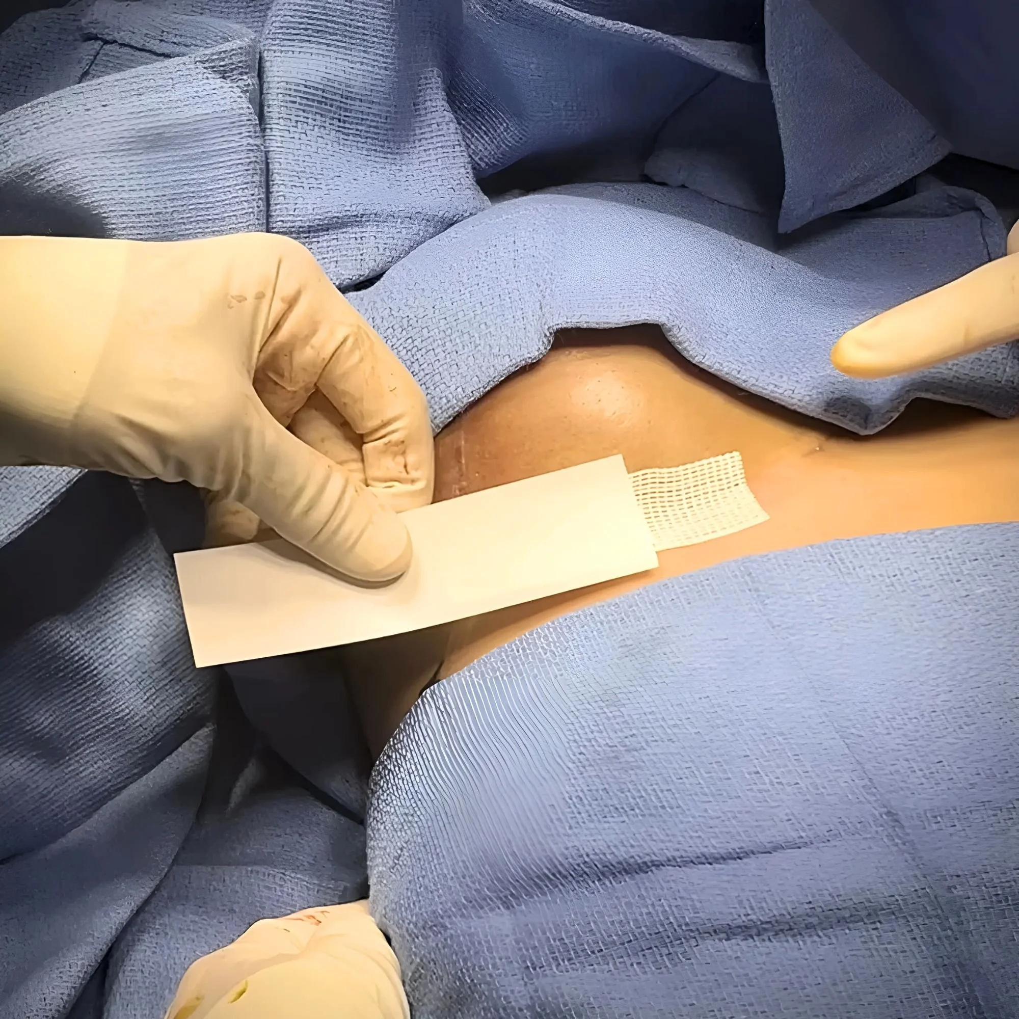 SYLKE | SYLKE Adhesive Wound Closure — Conduit
