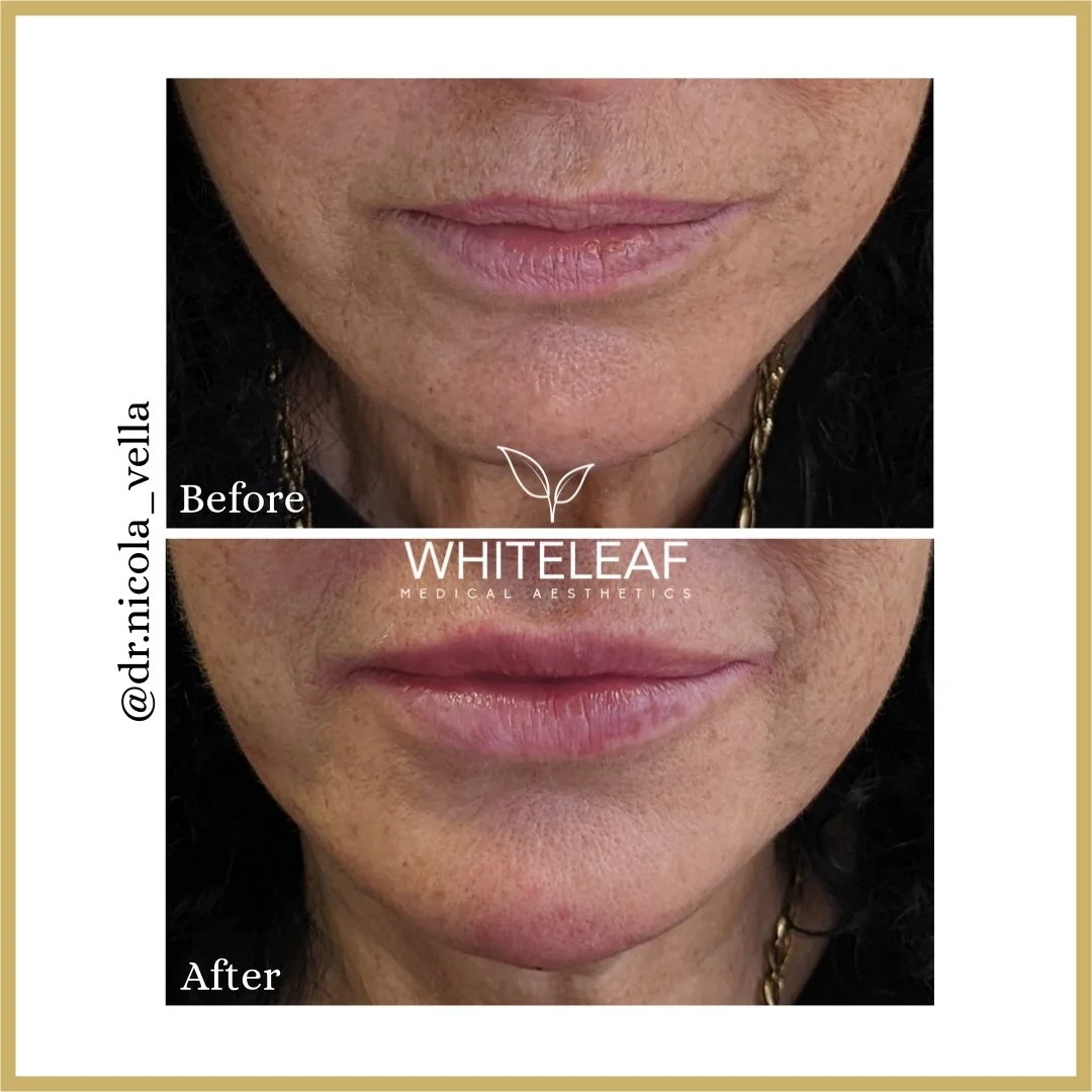 Gallery before / after photos of Botox and dermal filler. — Whiteleaf ...