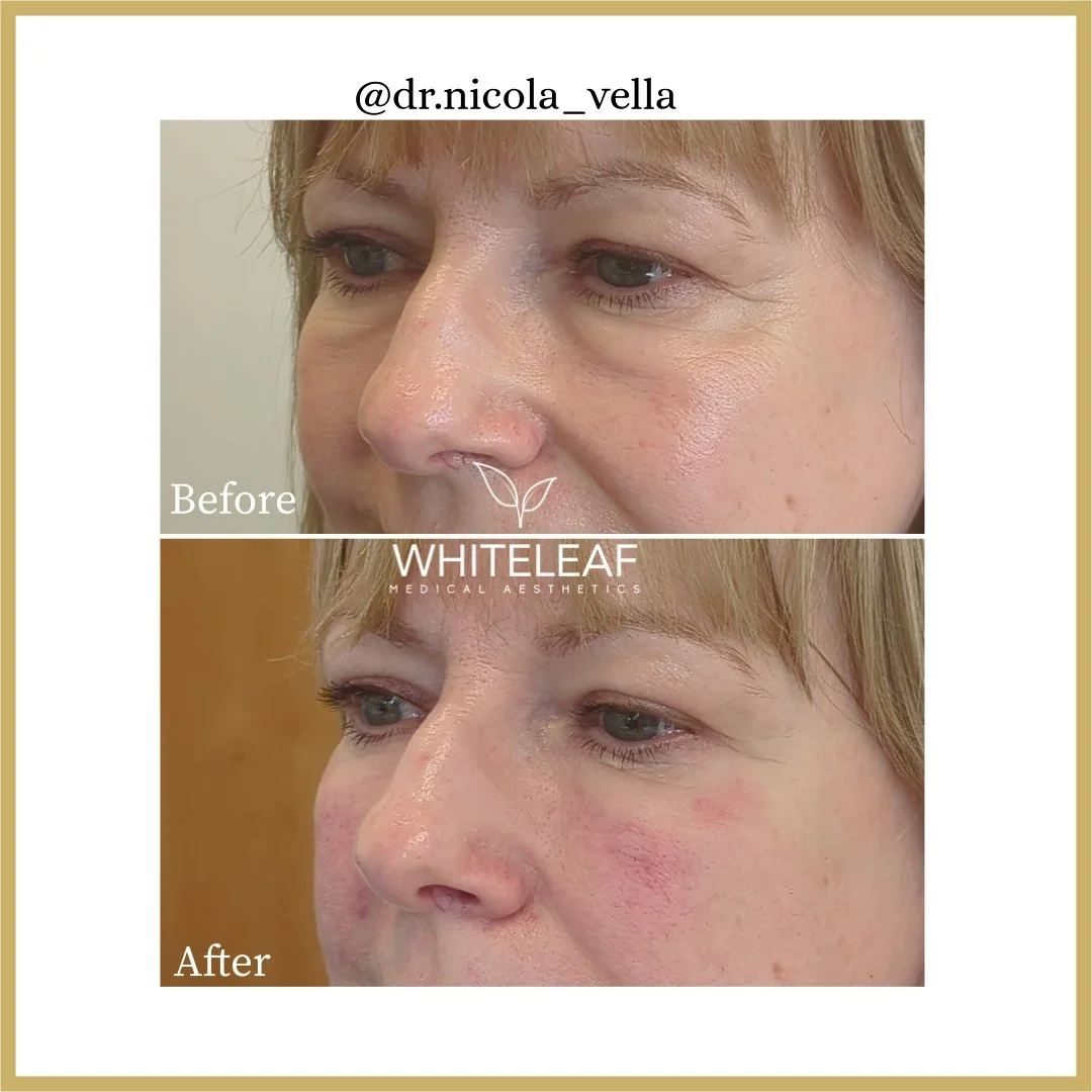 Mid-face rejuvenation — Whiteleaf Medical Aesthetics