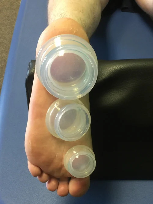 Myofascial Cupping for Plantar Fasciitis — Ashley Burr Athletic Therapy