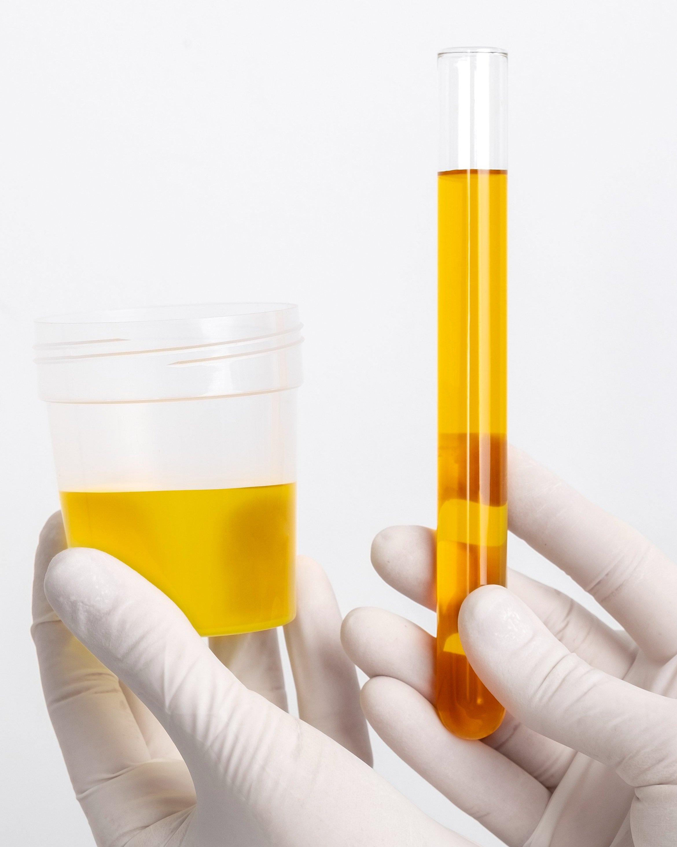 Elevated α-Synuclein Aggregate Levels in the Urine of Patients with ...