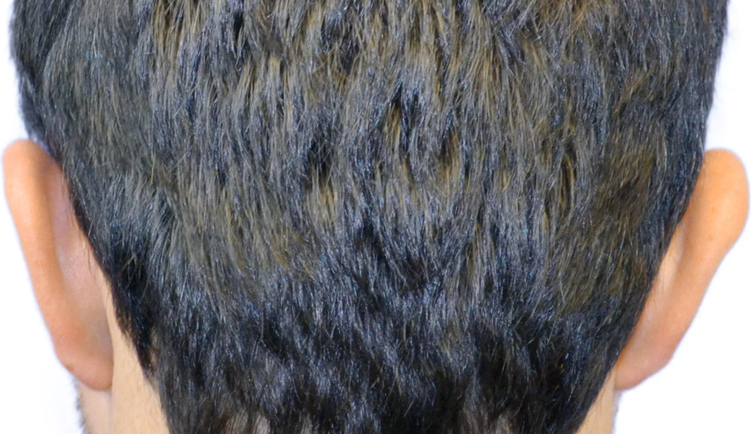 FUT vs FUE Hair Transplant: Comparing Transplant Techniques