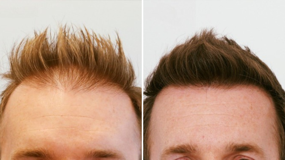 Hairline Transplant & Restoration Experts | Advanced Hair