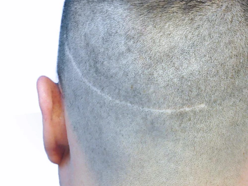 Scar Revision for Hair Transplants: New Improved Solution