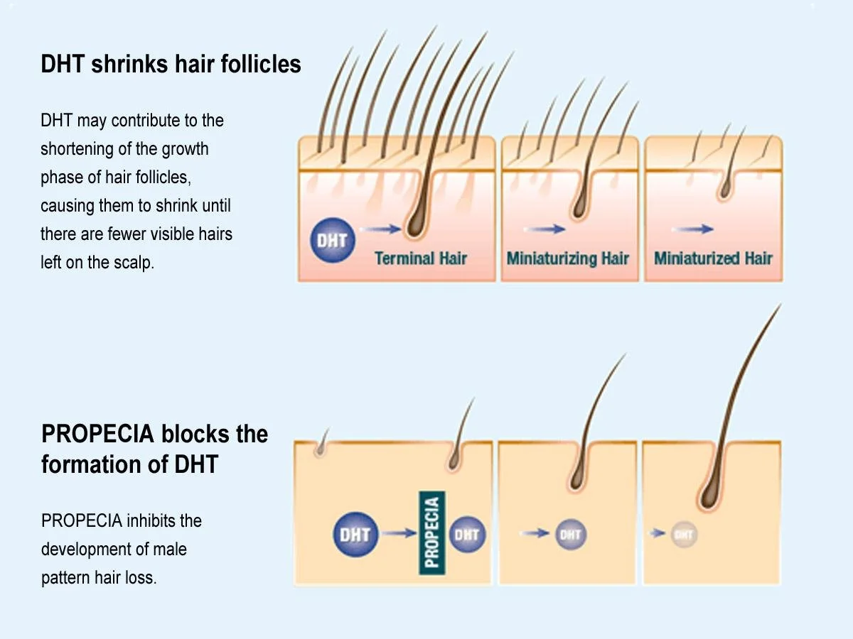 Hair Loss Solution: Prescriptions — Advanced Hair Restoration