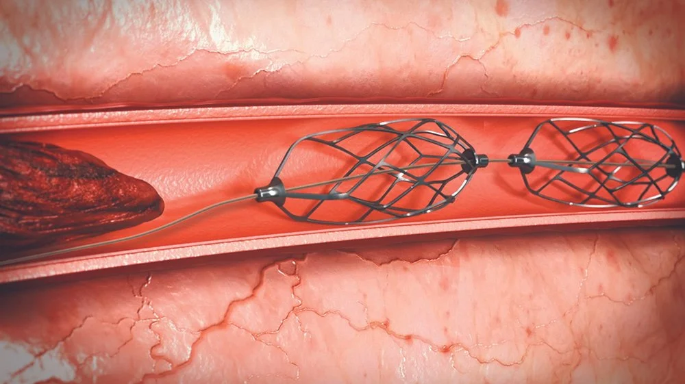 Product — Pounce™ Thrombectomy System