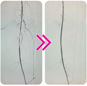 Case Reports — Pounce™ Thrombectomy System