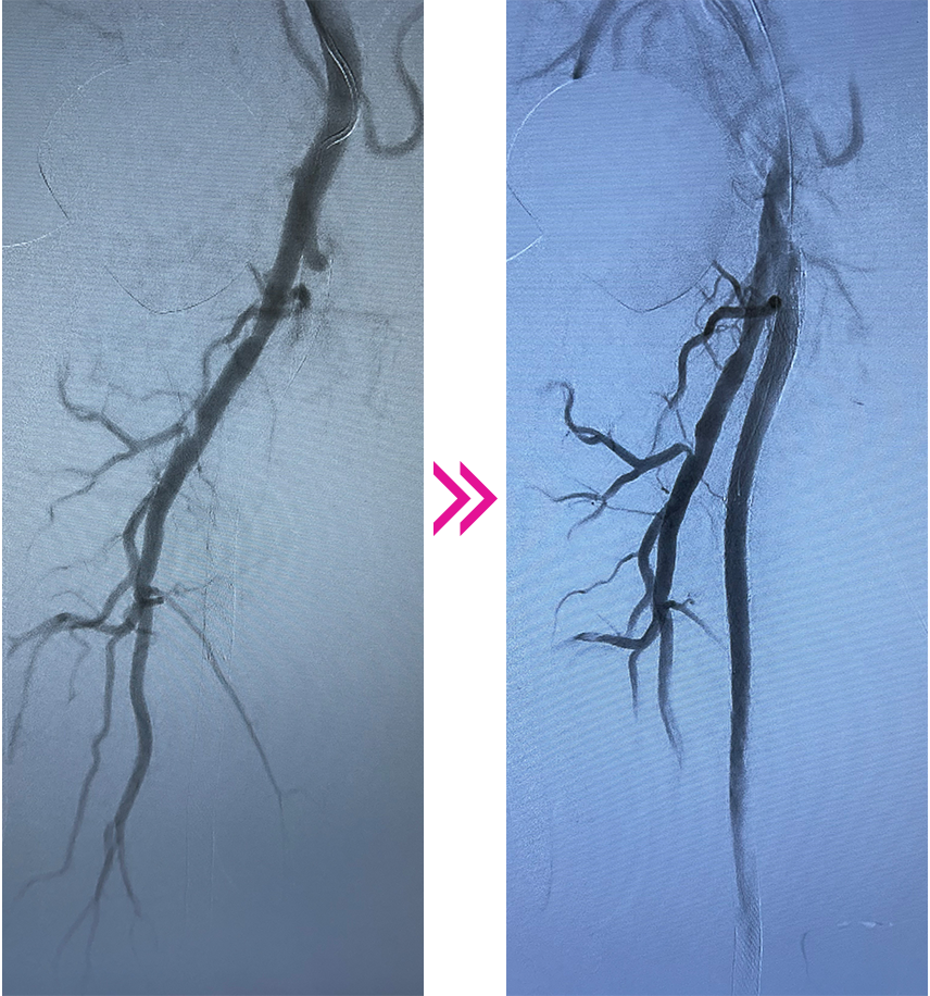 Product — Pounce™ Thrombectomy System