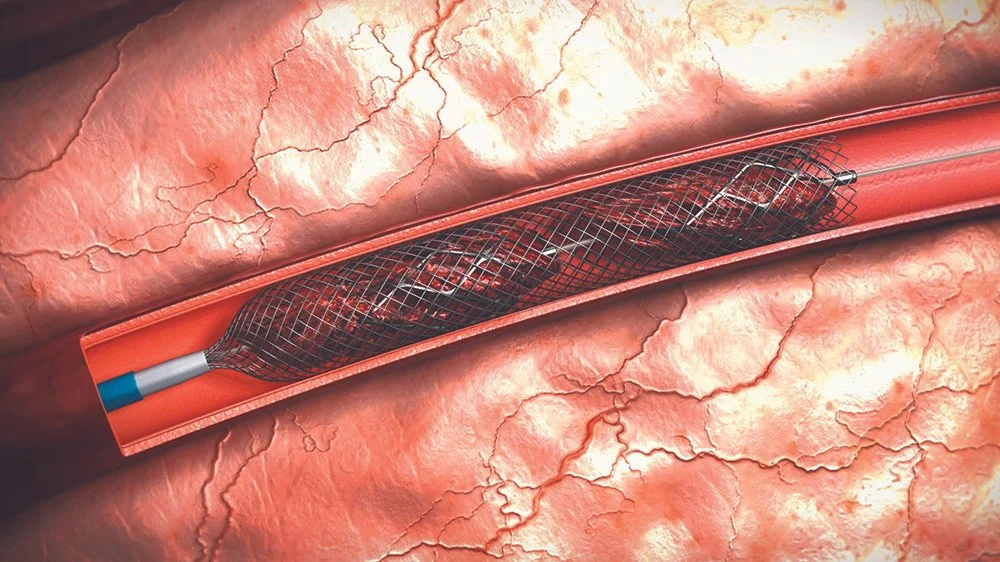 Product — Pounce™ Thrombectomy System