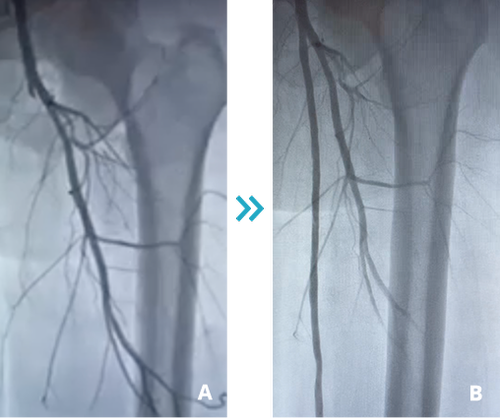 Pounce™ Platform — Pounce™ Thrombectomy System