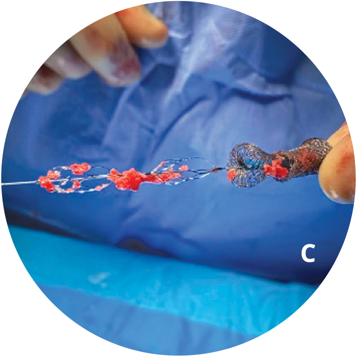 Pounce™ Platform — Pounce™ Thrombectomy System
