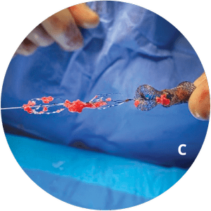 Pounce™ Platform — Pounce™ Thrombectomy System