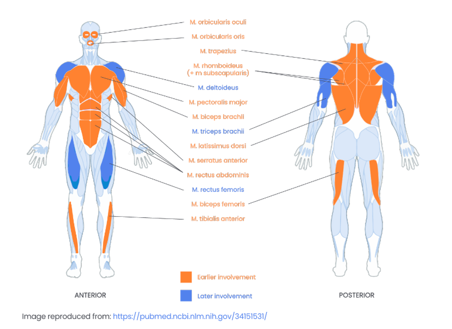 Facioscapulohumeral Muscular Dystrophy (FSHD) — Physio Express