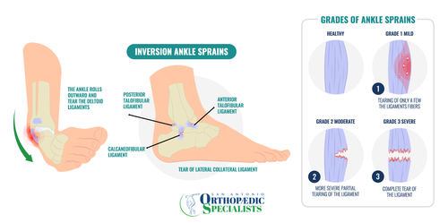 Understanding Sprains vs. Broken Bones: Key Differences — San Antonio ...